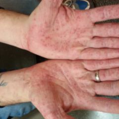 Stomatitis aphthosa - DocCheck Flexikon