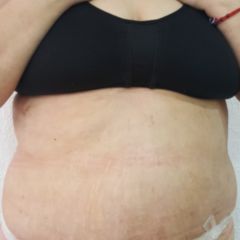 Wertheim-Meigs-Operation - DocCheck Flexikon