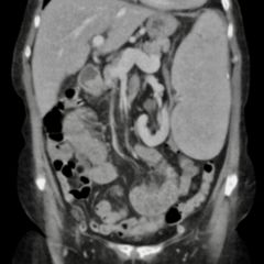 Splenomegalie - DocCheck Flexikon