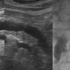 Pankreatitis - DocCheck Flexikon
