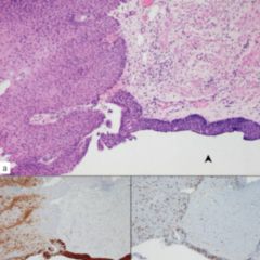 Intraduktale papillär-muzinöse Neoplasie - DocCheck Flexikon