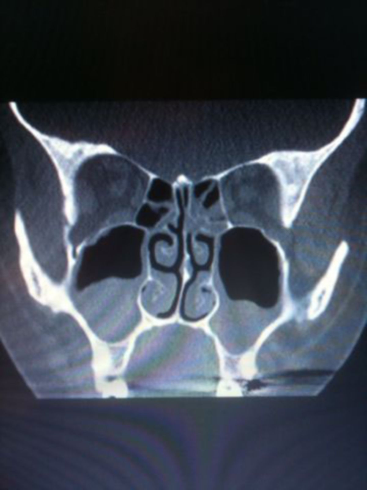 Chronische Pansinusitis 6 - DocCheck