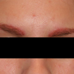 Epikutantest - DocCheck Flexikon