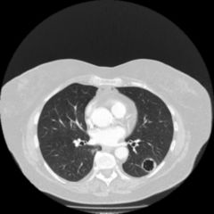 Lungengewebe - DocCheck Flexikon