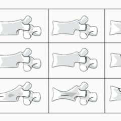 Genant-Klassifikation - DocCheck Flexikon