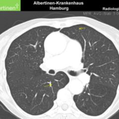 Kongenitales lobäres Emphysem - DocCheck Flexikon