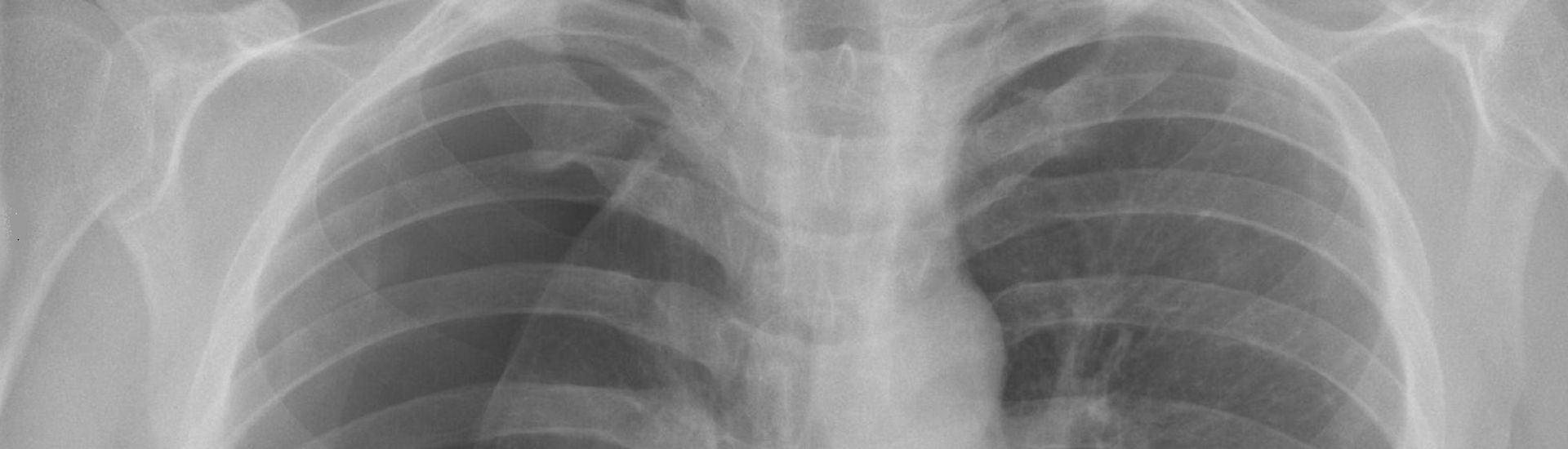 Röntgen-Thorax sagt Sterblichkeit voraus - DocCheck