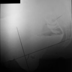 Descensus ovarii - DocCheck Flexikon