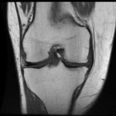 Eminentia intercondylaris - DocCheck Flexikon