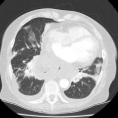Mediastinitis - DocCheck Flexikon