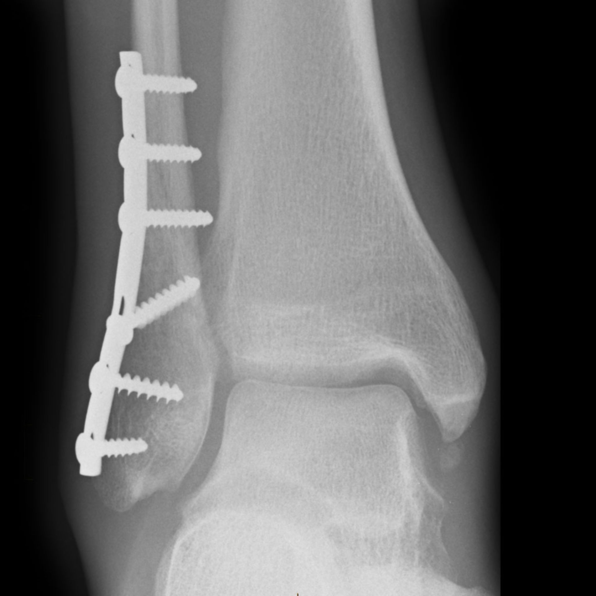 Ankle Fractures Ankle Fractures