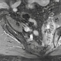 Sakroiliitis - DocCheck Flexikon