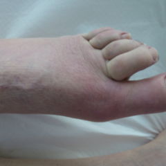 Podagra - DocCheck Flexikon