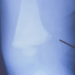 Four-Corner-Fusion - DocCheck Flexikon