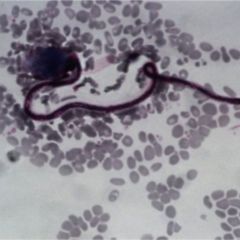 Elephantiasis - DocCheck Flexikon