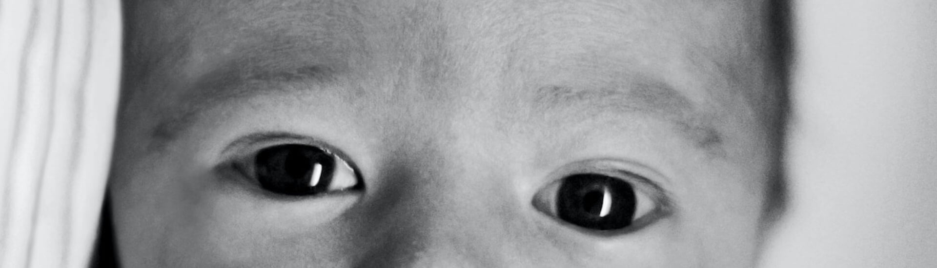 Glaukom: Die schönen großen Augen - DocCheck