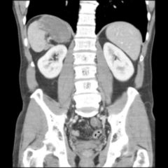 Situs inversus - DocCheck Flexikon