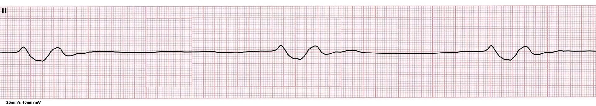 EKG-Abbildung PEA III - DocCheck