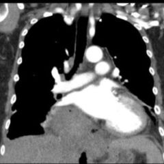 Fundoplikatio - DocCheck Flexikon