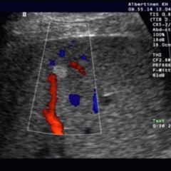 Hamartomatös - DocCheck Flexikon