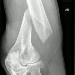 Humerusschaftfraktur - DocCheck Flexikon