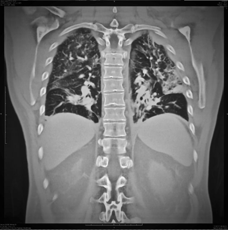 Rippenserienfraktur-Lungenkontusion - DocCheck