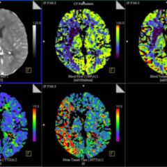 CT-Perfusion - DocCheck Flexikon