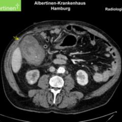Cholezystitis - DocCheck Flexikon