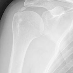 Tendinosis calcarea der Schulter - DocCheck Flexikon