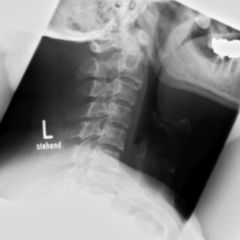 HWS-Syndrom - DocCheck Flexikon