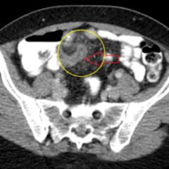 Mesocolon ascendens - DocCheck Flexikon