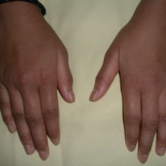 Daktylitis - DocCheck Flexikon