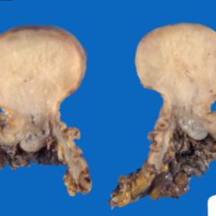 Inflammatorisches Mammakarzinom - DocCheck Flexikon