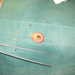 Totale mesorektale Exzision - DocCheck Flexikon