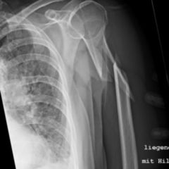 Humerusschaftfraktur - DocCheck Flexikon