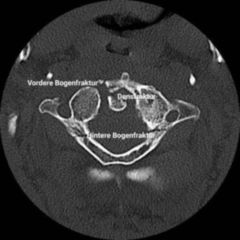 Atlasfraktur - DocCheck Flexikon