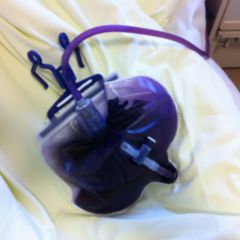 Purple Urine Bag Syndrome - DocCheck Flexikon