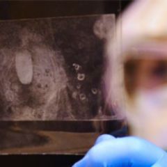 Rovsing-Symptom - DocCheck Flexikon