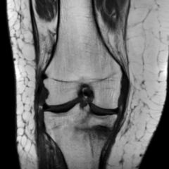 Ligamentum fundiforme clitoridis - DocCheck Flexikon