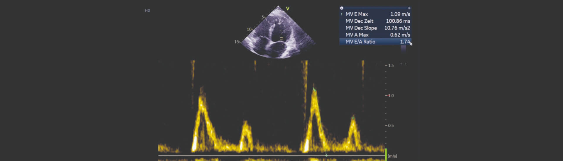 Echo-Interaktiv: Die diastolische Dysfunktion - DocCheck