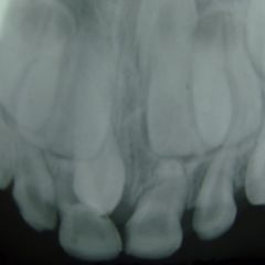 Hyperdontie - DocCheck Flexikon