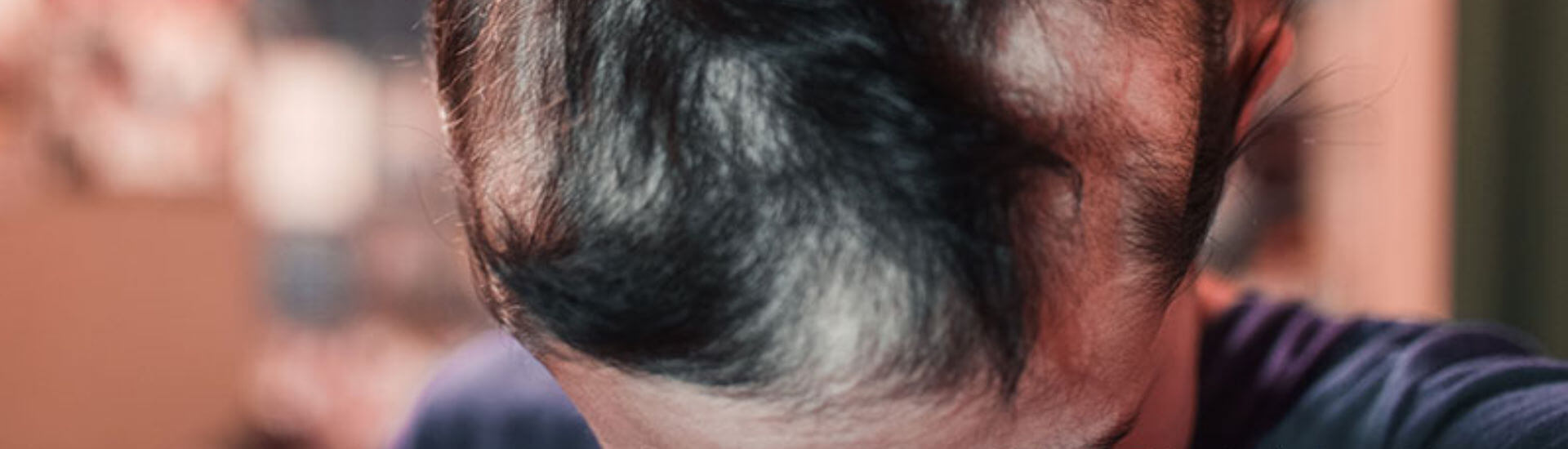 Strahlen-Alopezie: Chance auf neue Haare mit Minoxidil - DocCheck