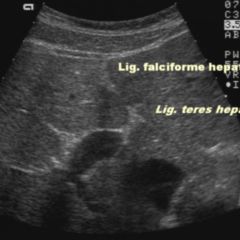 Ligamentum teres uteri - DocCheck Flexikon