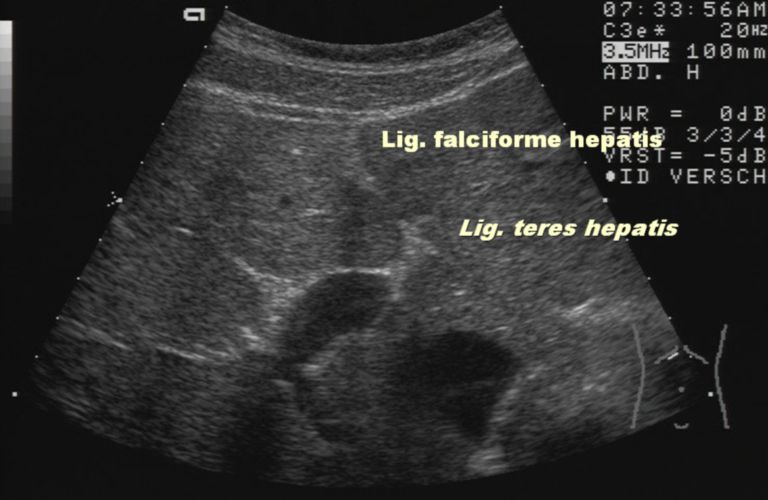 Falciform Ligament Ultrasound