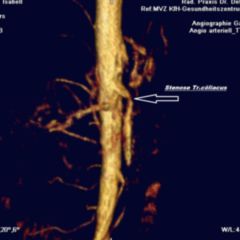 Truncus sympathicus - DocCheck Flexikon
