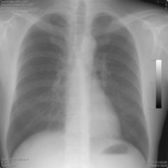 Röntgen-Thorax - DocCheck Flexikon