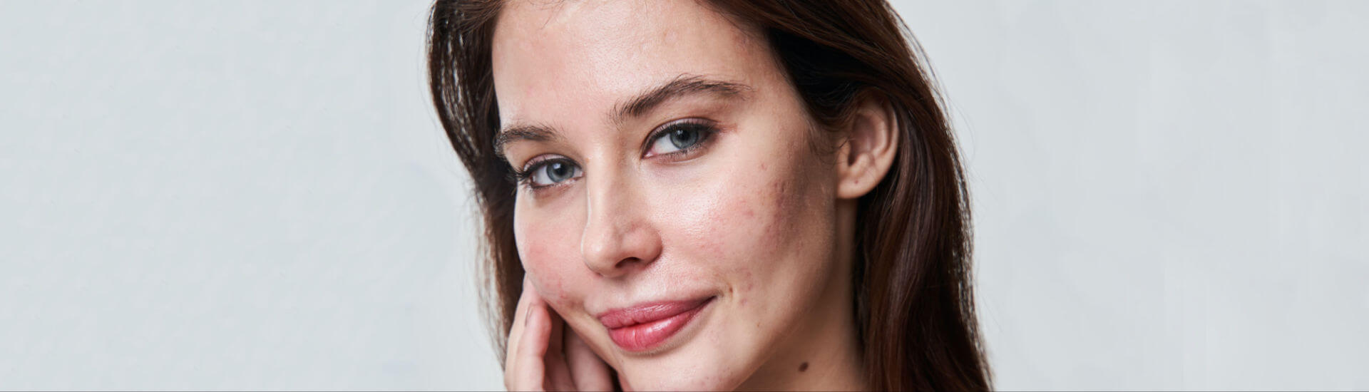 Akne-Therapie: Antibiose, BPO oder Retinol? - DocCheck