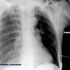Rippenfraktur - DocCheck Flexikon
