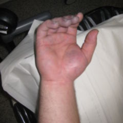 Akral - DocCheck Flexikon