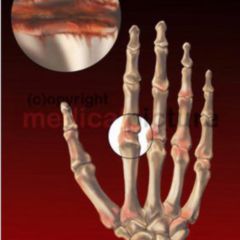 Digitus quintus varus - DocCheck Flexikon